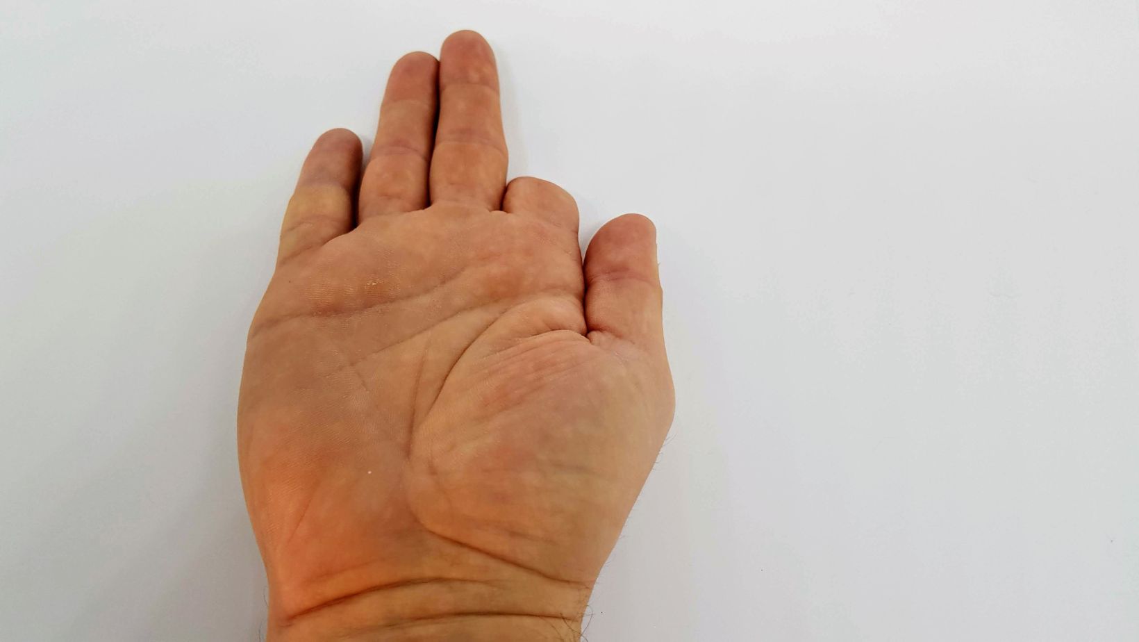 The Science Behind Replantation: Restoring Amputated Digits